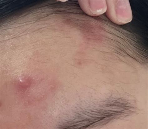 얼굴에 염증 지식in