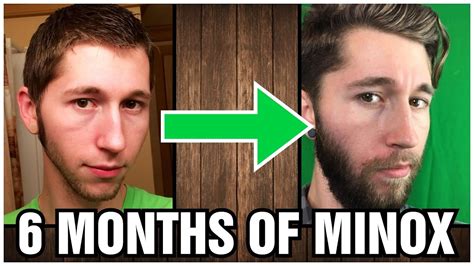 Minoxidil Beard Before And After Minoxidil Can Used For Beard Although