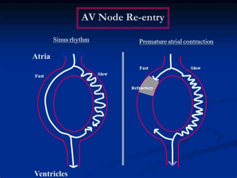 Atrioventricular Nodal Re Entrant Tachycardia Hope For Hearts