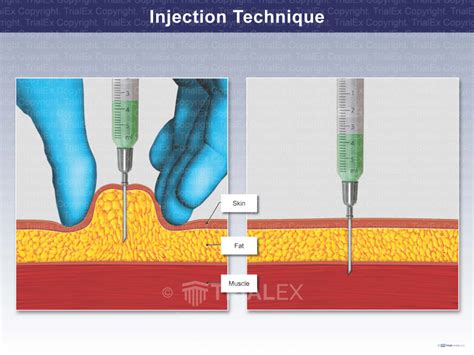 Injection Technique Trialquest Inc