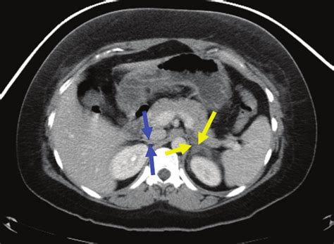 Cross Sectional Abdominal Ct Scan With Thickening And Stranding Yellow Download Scientific