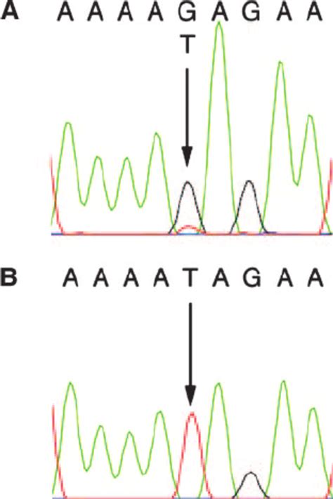 Somatic G To T Transversion Mutation In Apc Resulting In A Termination