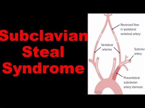 Subclavian Steal Syndrome Ultrasound