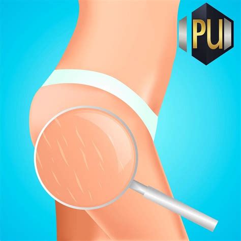 Causes And Preventions Of Stretch Marks