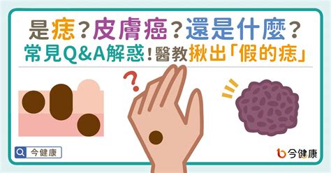 是痣？皮膚癌？還是什麼？常見qanda解惑！醫教揪出「假的痣」 今健康