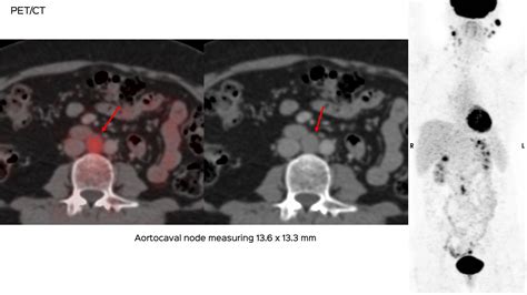 Case 134 Aortocaval Node Biopsy