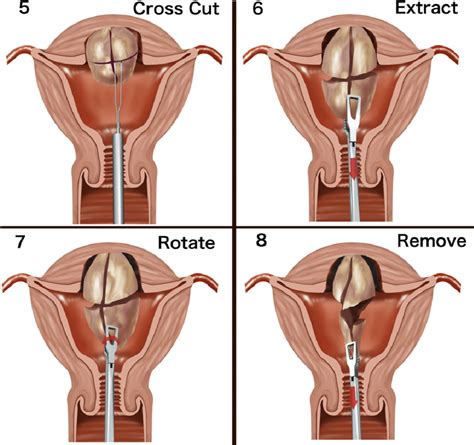 Hysteroscopic Myomectomy