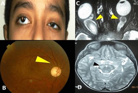 Segmenting Pediatric Optic Pathway Gliomas Using Deep Learning