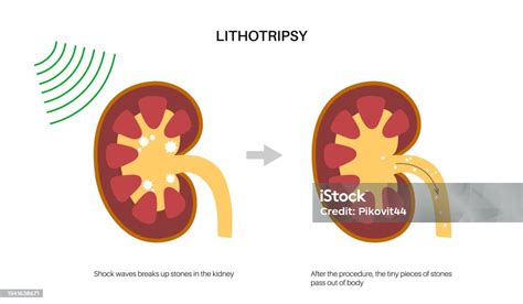 Lithotripsy Procedure Concept Stock Illustration Download Image Now