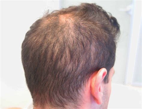Hair Loss Classification In Men Defining Types And Stages