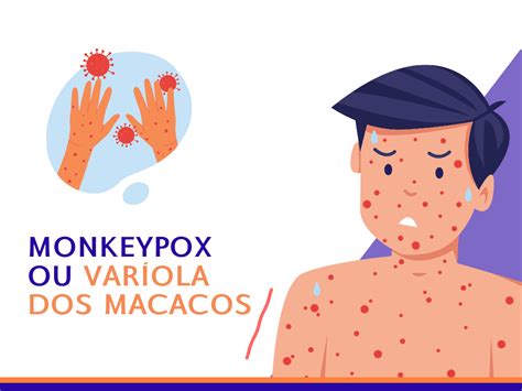 Monkeypox ou Varíola dos Macacos Laboratório São Paulo