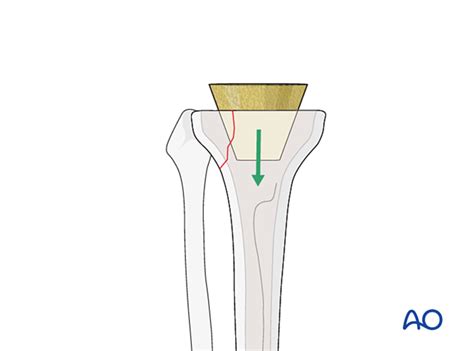 Complete Tibial Revision With Varusvalgus Cck System For Fracture