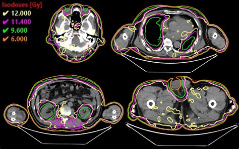 Dose Distributions Of Different Computed Tomography Slices Including