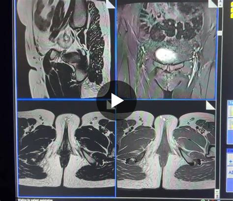 Hypoplastic Uterus Hashir Imtiyaz