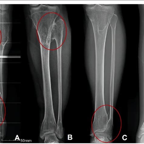 Measurement Of Radiographic Angle Of Mpta And Ldta The Mpta Is Download Scientific Diagram
