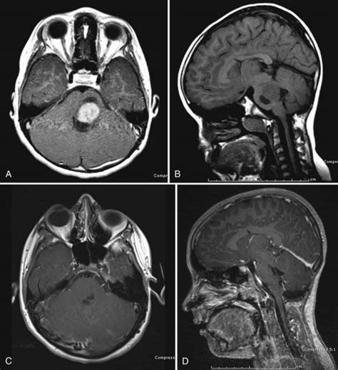 Brainstem Glioma Neupsy Key