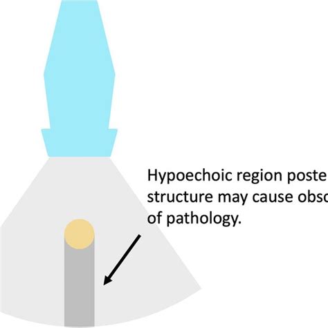 Beam Width Ultrasound Beam Has Focal Narrowing Before Widening Back