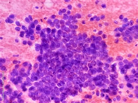 Photomicrograph Of Fine Needle Aspiration Fna Cytology Of A Pulmonary