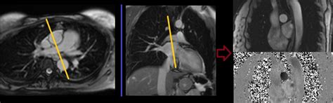Cardiac Mri Flow Quantification Protocols Planning And Techniques