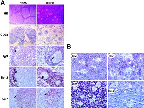 Activation Induced Cytidine Deaminase Aid Deficiency Causes The Autosomal Recessive Form Of