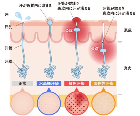 あせも（汗疹） 板橋区成増駅前かわい皮膚科
