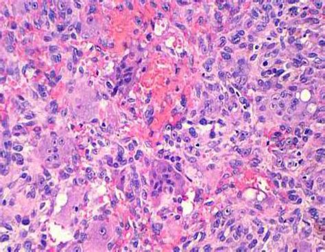 Figure 3 From Giant Cell Fibroma A Case Report Semantic Scholar