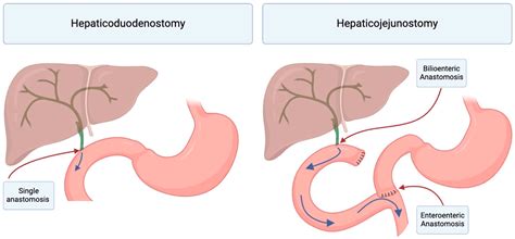 Biliary Reconstruction With Hepaticoduodenostomy Versus
