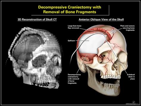 Decompressive Craniectomy With Removal Of Bone Fragments