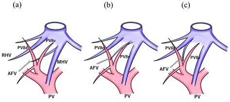 JPM Free Full Text Hepatic Vein Guided Approach In Laparoscopic Anatomic Liver Resection Of