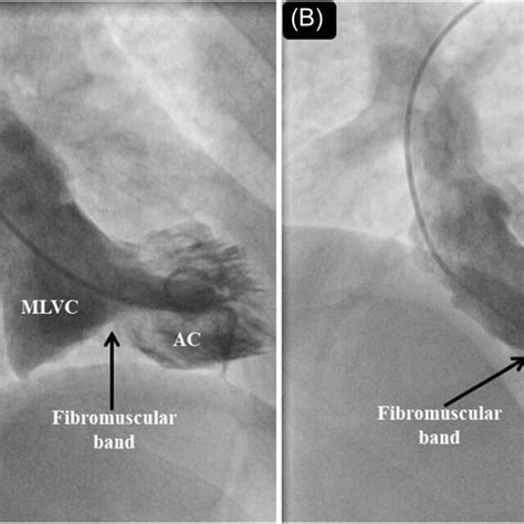Cardiac Catheterization Study Of Case 2—left Ventricular Angiogram