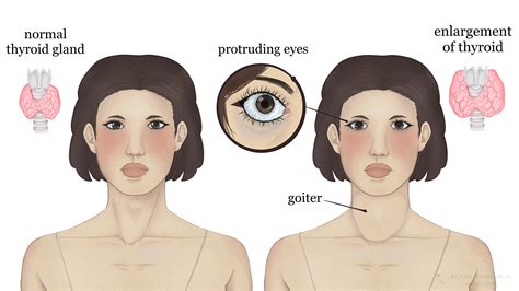Graves Disease Causes Diagnosis And Therapy Alpine Biomedical