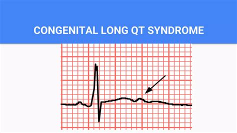 Abnormalities Of U Wave Pptx