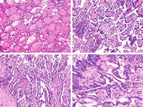 Follicular Colloid Of Thyroid