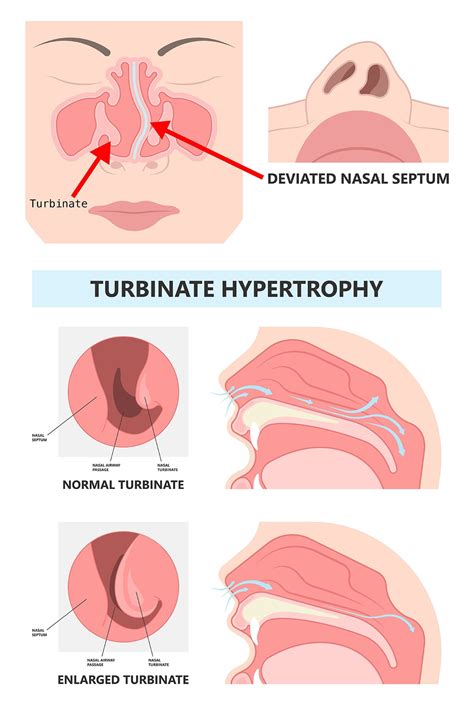 Deviated Septum Diagram