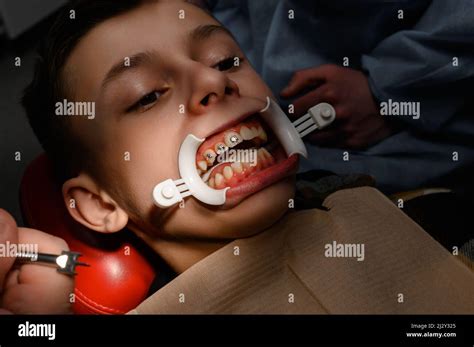 Close Up Of Installing Braces On Teeth Aligning Teeth With Braces