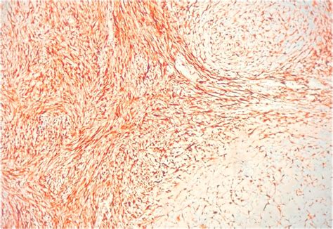 Very Rare Intraoral Appearance Of Ossifying Fibro Myxoid Tumor A Case
