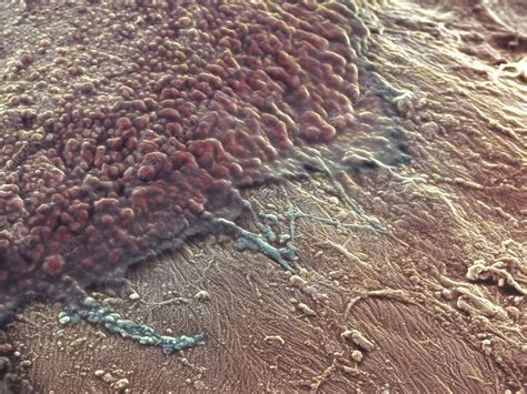 Bone Reabsorption Sem Stock Image P1050154 Science Photo Library