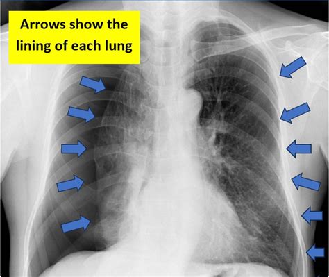 Chest Tube Pneumothorax Placement