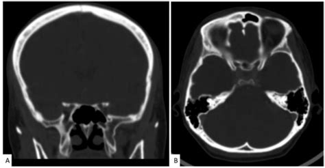 Non Contrasted Ct Scan Does Not Displaying Clinoidal Hyperostosis In Download Scientific