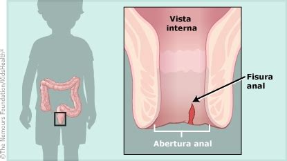 A Z Fisura Anal