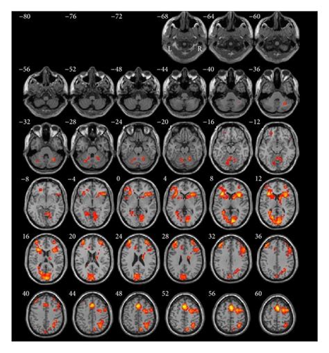 Normalized Brain Activation Maps Averaged Over 14 Participants At A