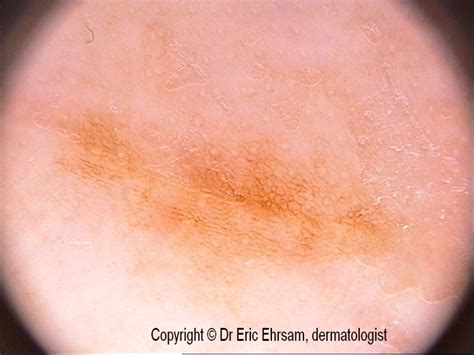 Dermoscopy Recurrent Nevus