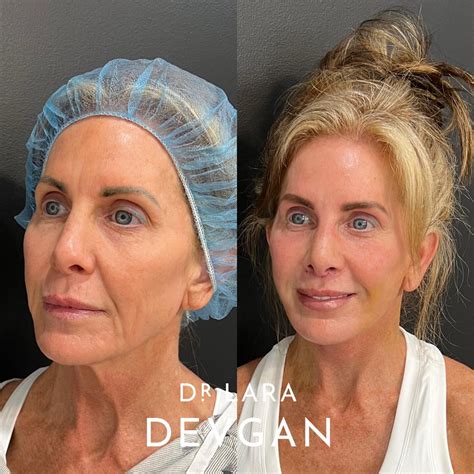 Signature Procedure Global Facial Optimization — Lara Devgan Md Mph
