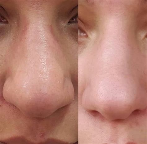 Full Face Fibroblast Before And After