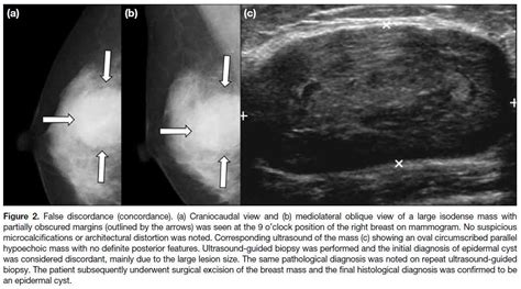 Ultrasound Histopathological Diagnoses Assess Benign Breast Lesions