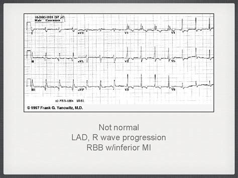 Normal ECG Rate And Rhythm Read Chapters 4