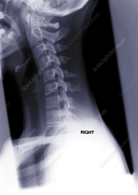 Human Vertebrae X Ray Stock Image F0299305 Science Photo Library