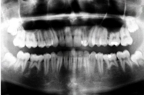 External Resorption Medizzy
