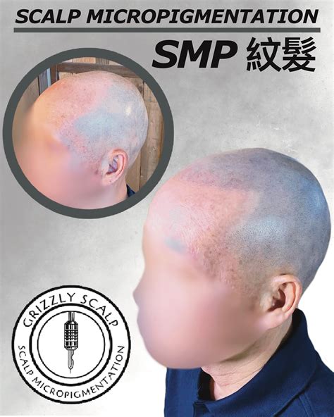 Hk 香港 Smp 紋髮 Bob Nggrizzly Scalp ｜多年紋髮經驗｜smp｜仿真毛囊｜紋髮課程｜ 班禿俗稱鬼剃頭，主要原因