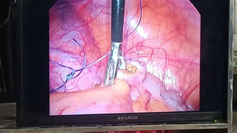 Laparoscopic Appendicectomy Youtube